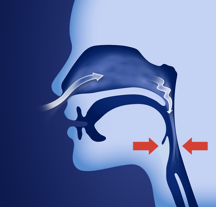 Arrêter de ronfler ! Simple et rapide avec l'orthèse Oniris
